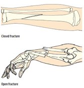 St John guide to treatment for fractures and dislocations